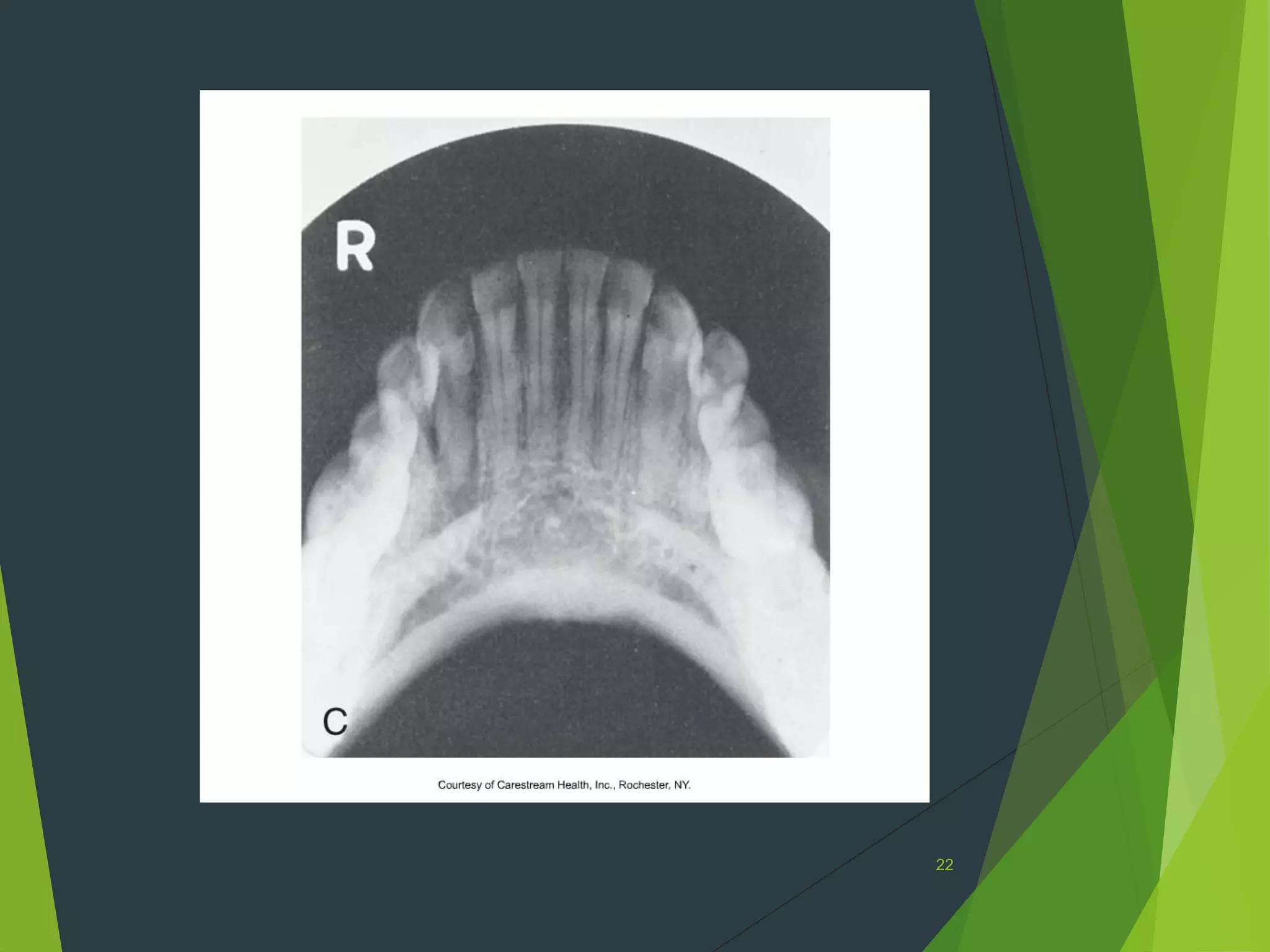 Chapter 21: Occlusal and Localization Technique | PPT