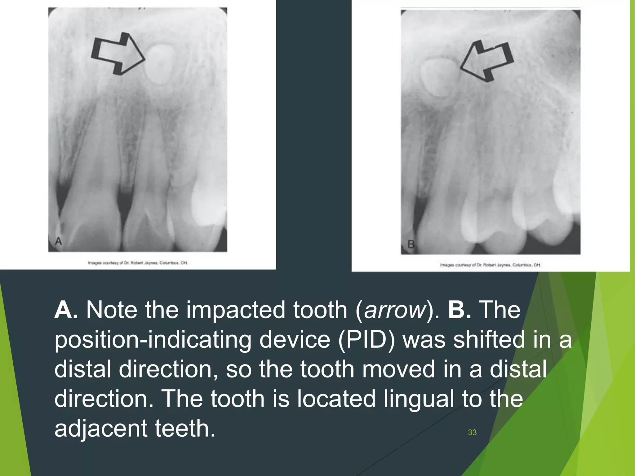 Chapter 21: Occlusal and Localization Technique | PPT