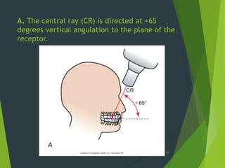 Chapter 21: Occlusal and Localization Technique | PPT