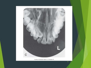 Chapter 21: Occlusal and Localization Technique | PPT