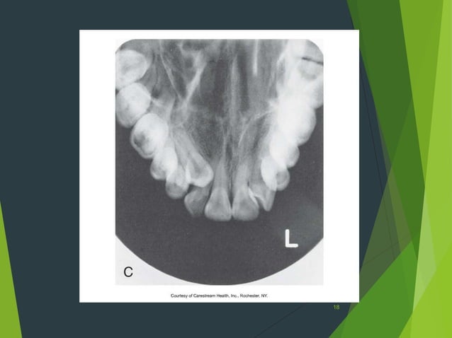 Chapter 21: Occlusal and Localization Technique | PPT