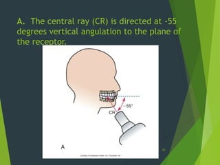 Chapter 21: Occlusal and Localization Technique | PPT