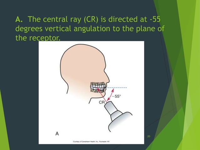 Chapter 21: Occlusal and Localization Technique | PPT