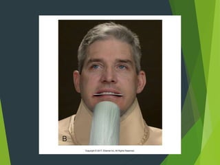 Chapter 21: Occlusal and Localization Technique | PPT