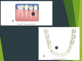 Chapter 21: Occlusal and Localization Technique | PPT