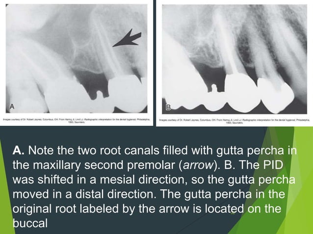 Chapter 21: Occlusal and Localization Technique | PPT