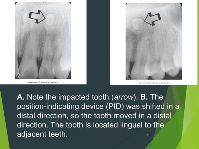 Chapter 21: Occlusal and Localization Technique | PPT