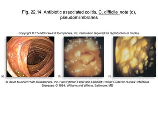 gastrointestinal tract disease - ncm 116 | PPT