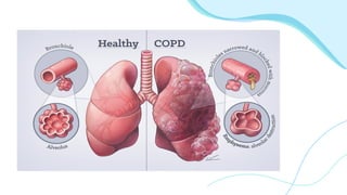 COPD-Chronic Obstructive Pulmonary Disease | PDF