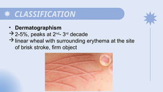 CHAPTER 352- URTICARIA HARRISONS SUMMARY | PPTX