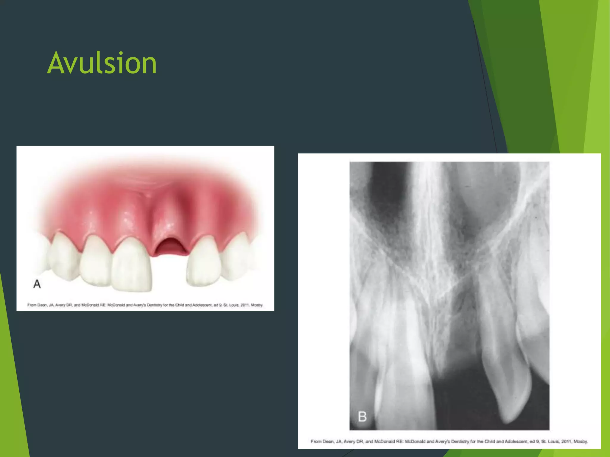 Chapter 35: Interpretation of Trauma, Pulpal Lesions, and Periapical ...