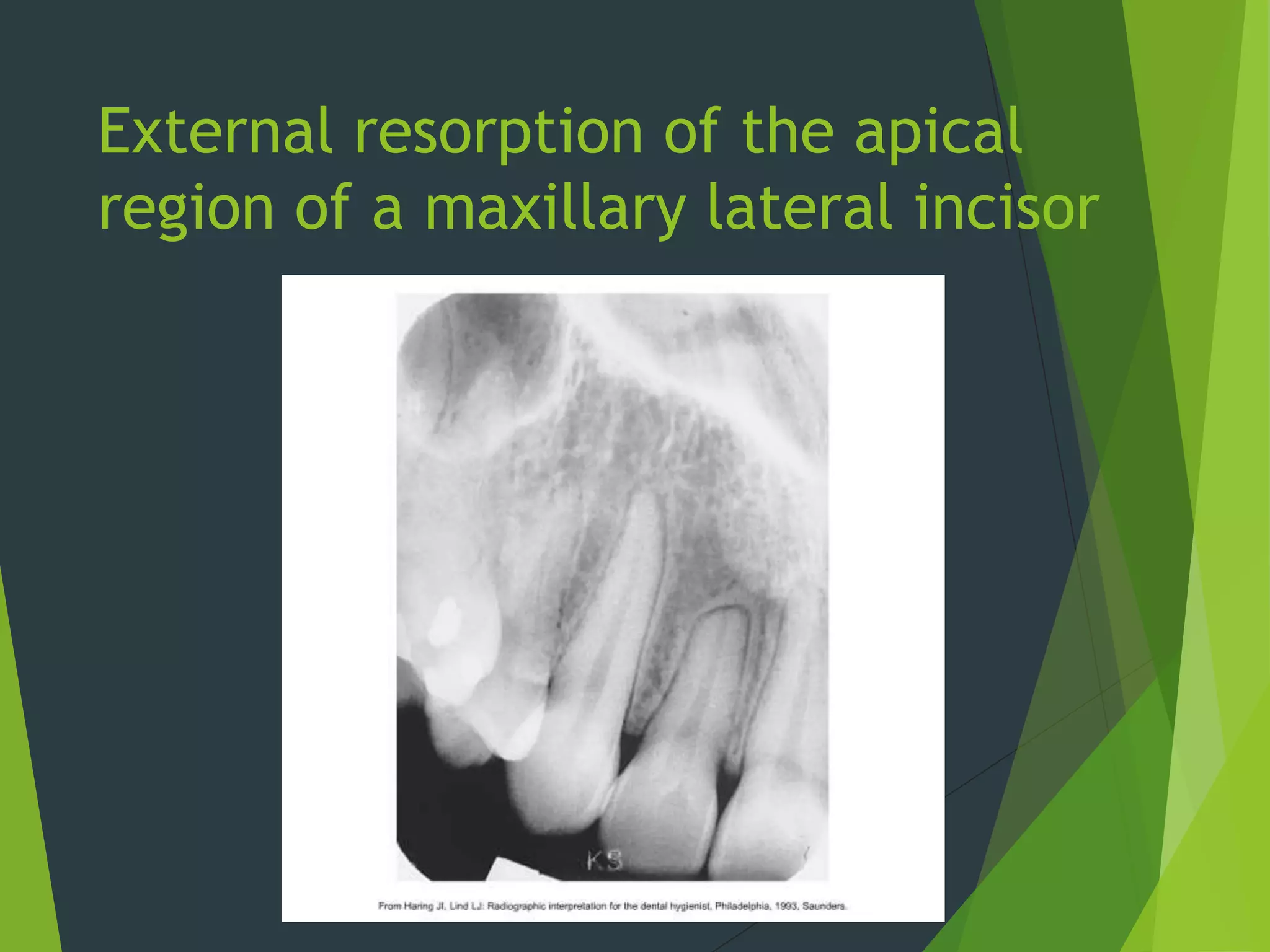 Chapter 35: Interpretation of Trauma, Pulpal Lesions, and Periapical ...