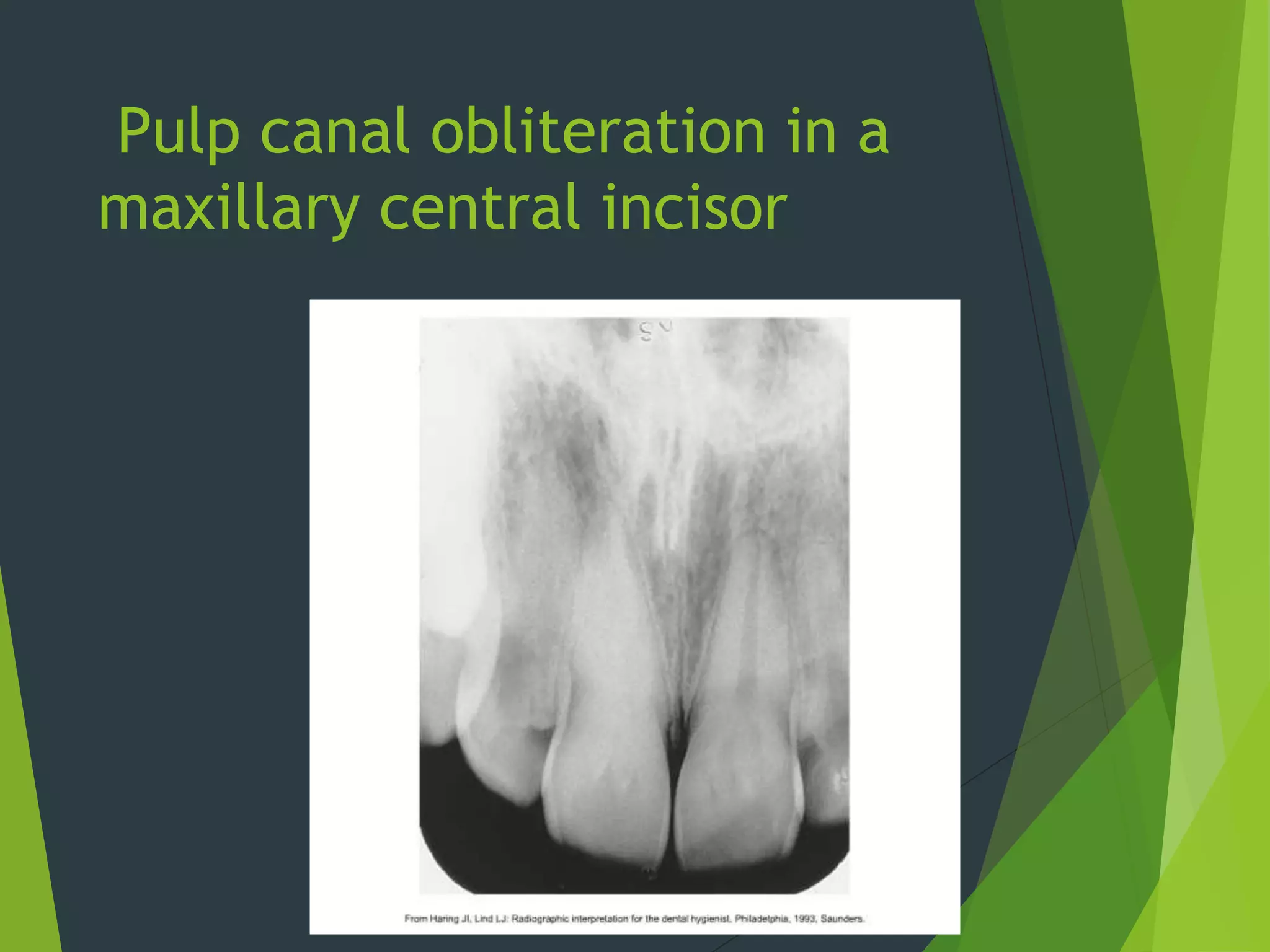 Chapter 35: Interpretation of Trauma, Pulpal Lesions, and Periapical ...