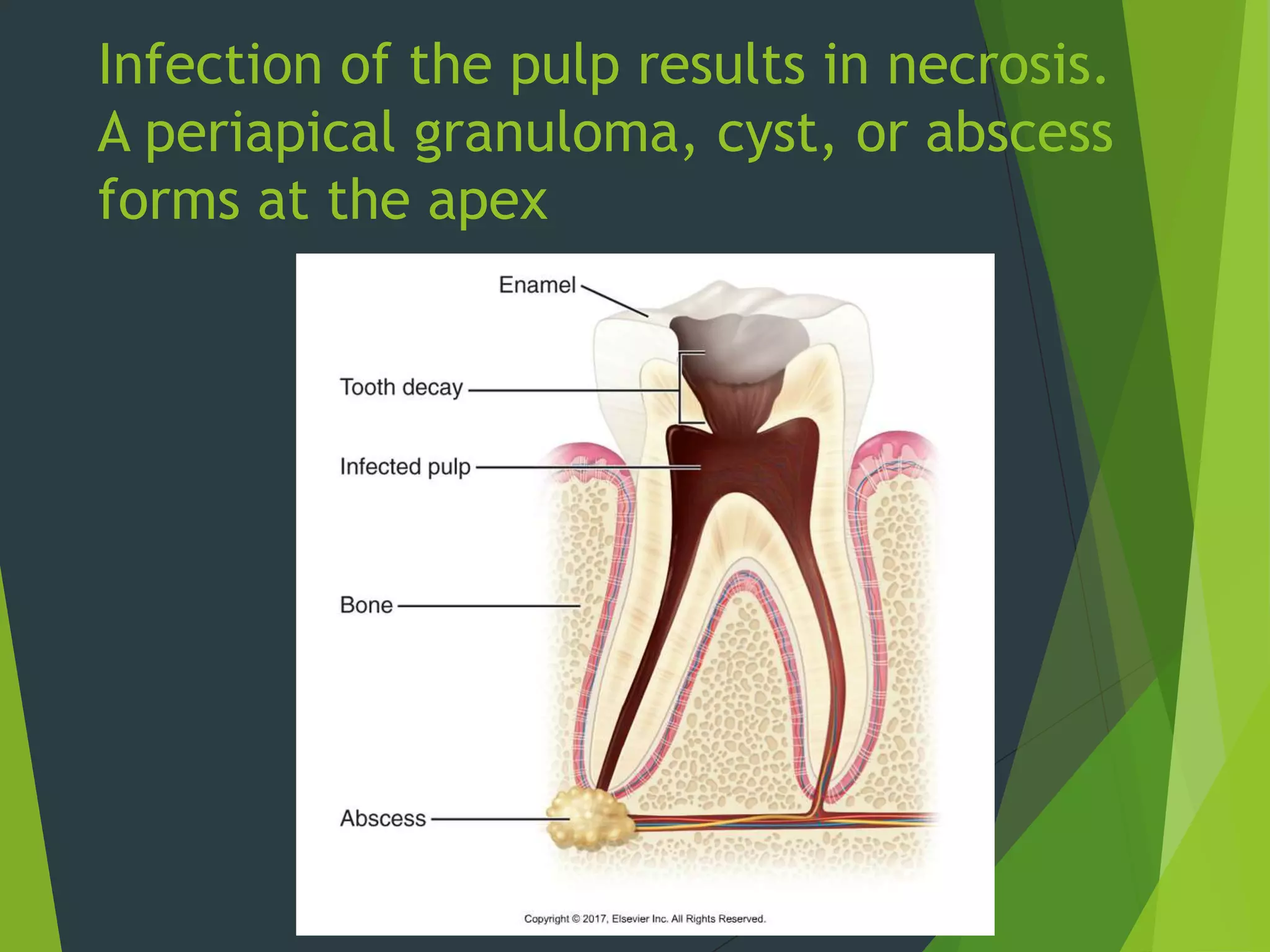 Chapter 35: Interpretation of Trauma, Pulpal Lesions, and Periapical ...