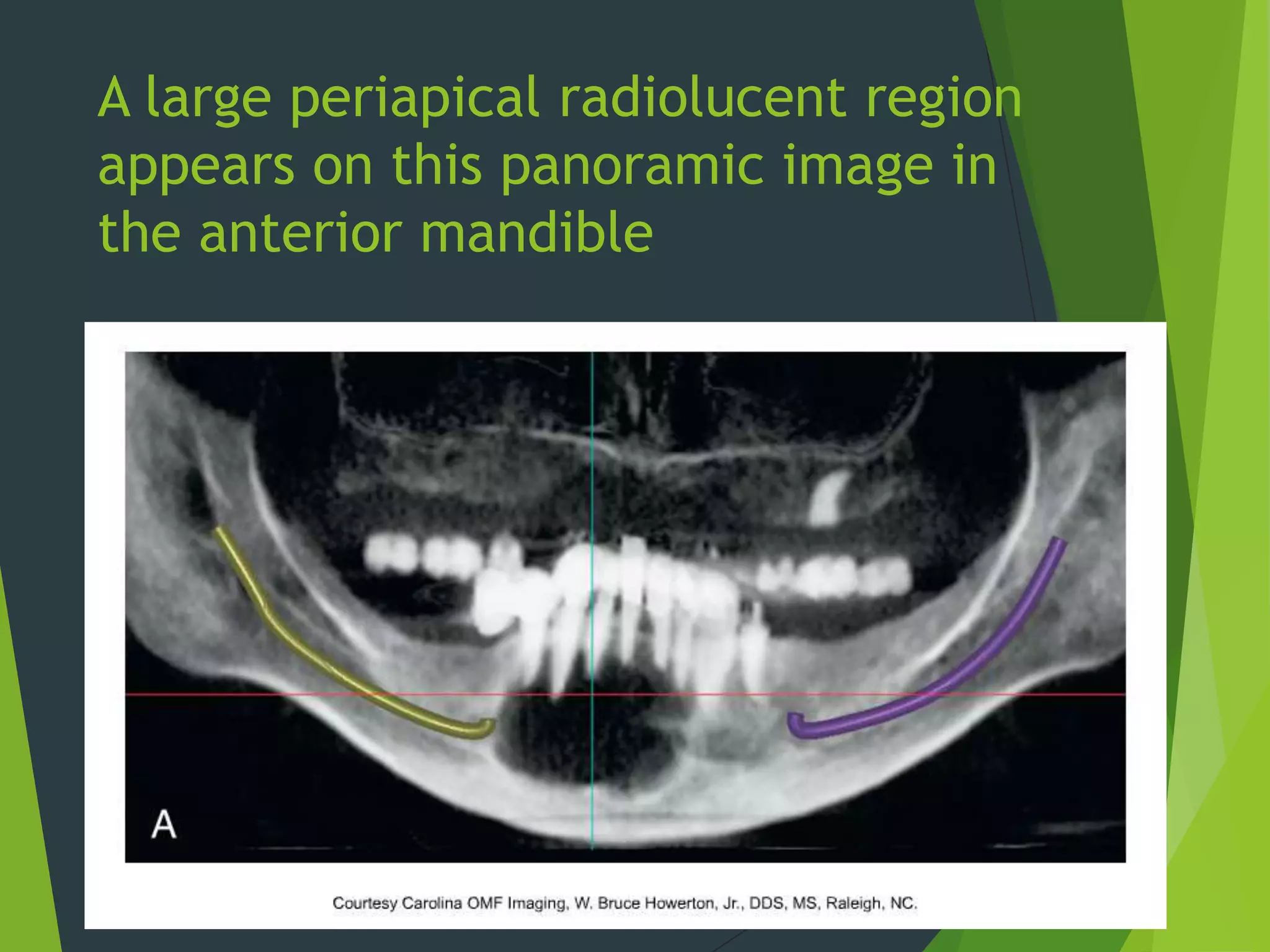 Chapter 35: Interpretation of Trauma, Pulpal Lesions, and Periapical ...