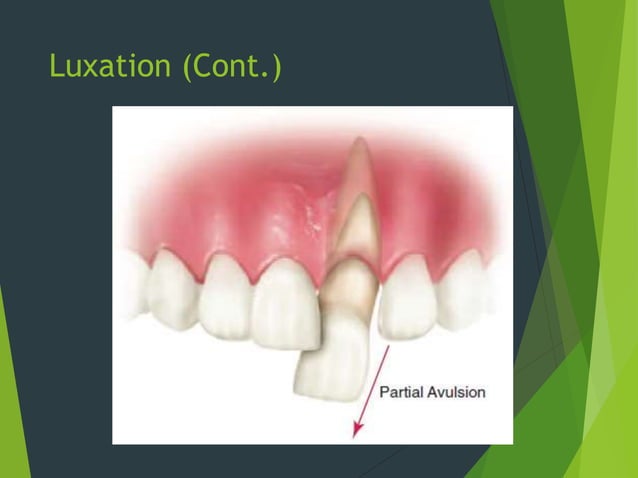 Chapter 35: Interpretation of Trauma, Pulpal Lesions, and Periapical ...