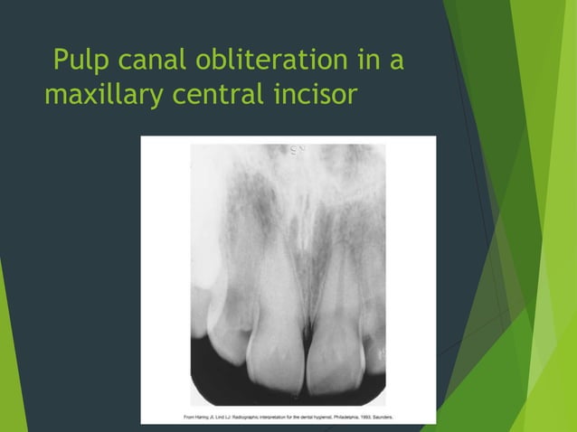 Chapter 35: Interpretation of Trauma, Pulpal Lesions, and Periapical ...