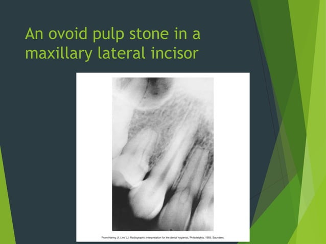 Chapter 35: Interpretation of Trauma, Pulpal Lesions, and Periapical ...