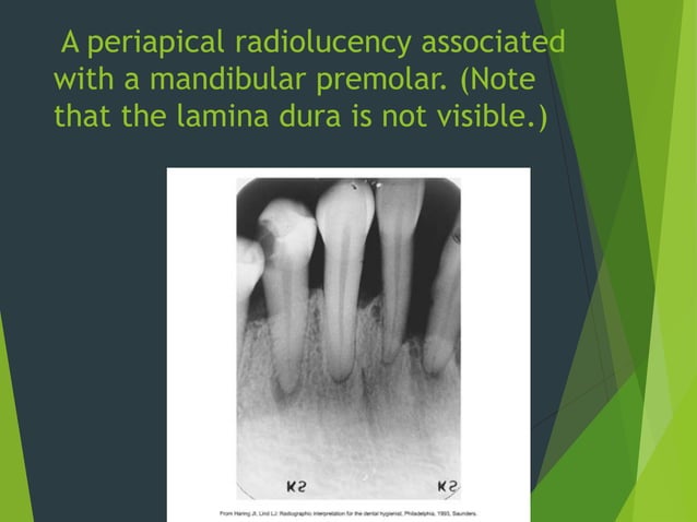 Chapter 35: Interpretation of Trauma, Pulpal Lesions, and Periapical ...