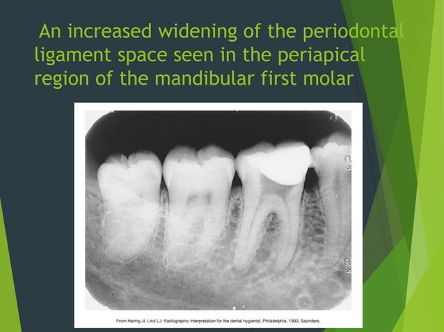 Chapter 35: Interpretation of Trauma, Pulpal Lesions, and Periapical ...
