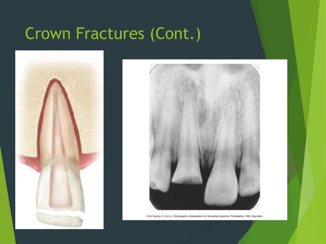 Chapter 35: Interpretation of Trauma, Pulpal Lesions, and Periapical ...