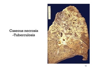 Necrosis | PPT | Digestive Disorders | Diseases and Conditions