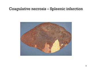 Necrosis | PPT | Digestive Disorders | Diseases and Conditions