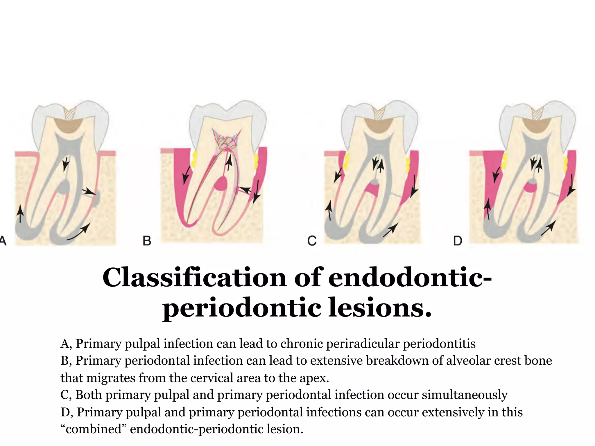 Diagnosis and Management of Endodontic-Periodontic Lesions | PDF