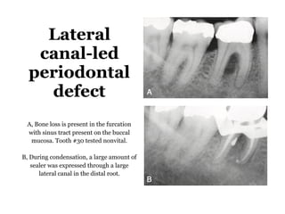 Diagnosis and Management of Endodontic-Periodontic Lesions | PDF