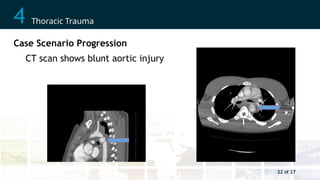 Chapter 4_ Thoracic Trauma.pptx ATLS..... | PPTX