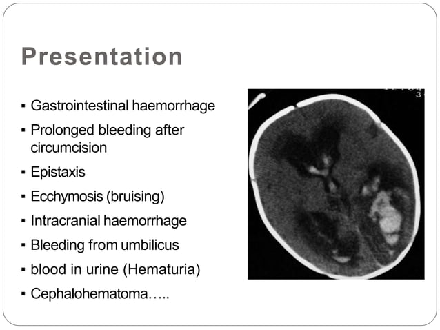 Chapter Five Hemorrhagic diseases of Newborn | PPT | Free Download