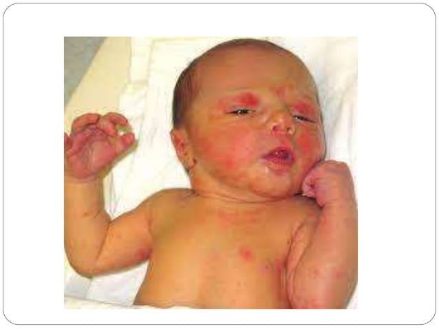 Chapter Five Hemorrhagic diseases of Newborn | PPT | Free Download