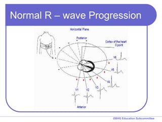 Chapter 5 - Making Sense of the 12 Lead | PPT