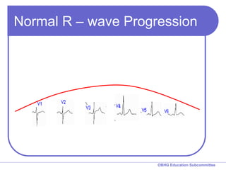 Chapter 5 - Making Sense of the 12 Lead | PPT