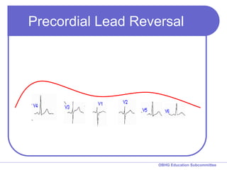 Chapter 5 - Making Sense of the 12 Lead | PPT