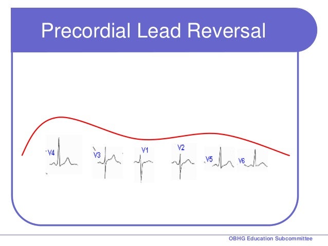 Chapter 5 - Making Sense of the 12 Lead