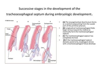 chapter 6-1 Esophageal atresia and TEF.ppt