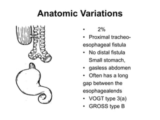chapter 6-1 Esophageal atresia and TEF.ppt