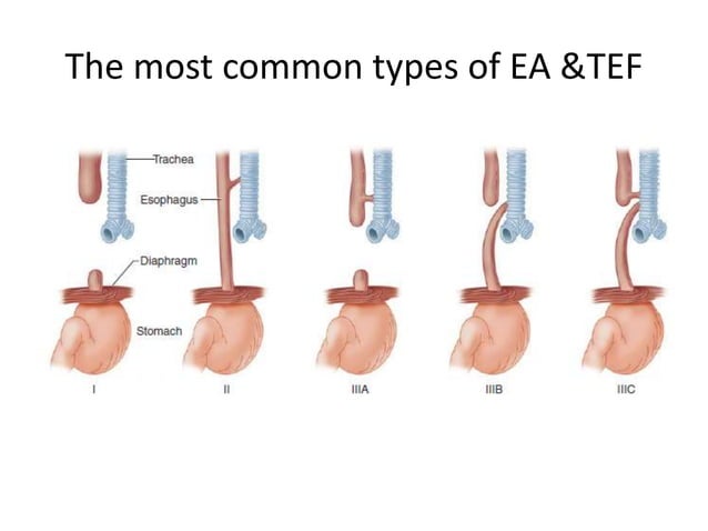 chapter 6-1 Esophageal atresia and TEF.ppt