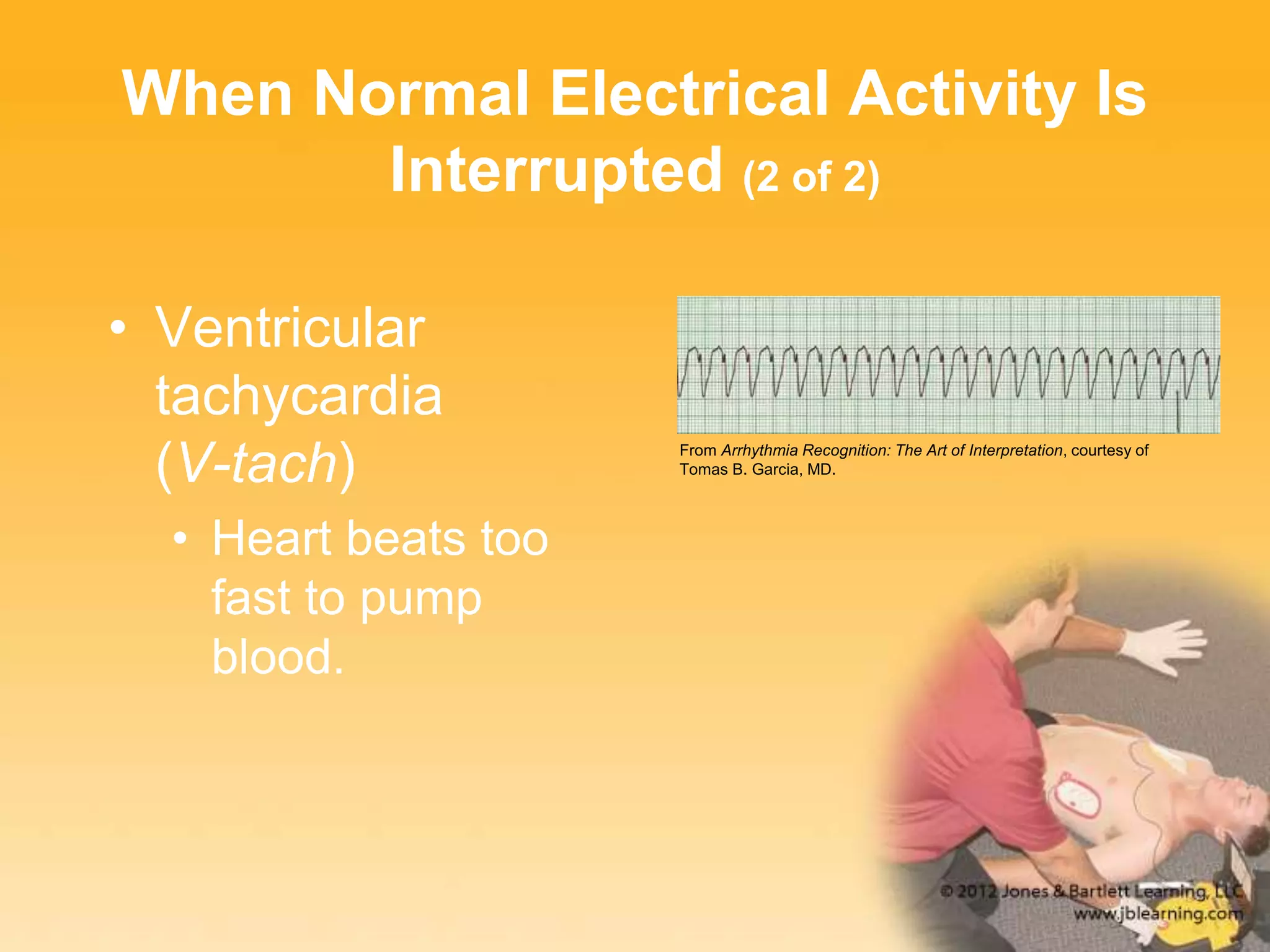 Chapter 6 Automated External Defibrillation | PPTX