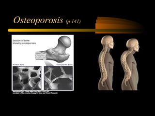 Chapter6 bonesmarieb | PPT | Death, Injury, or Military Conflict ...