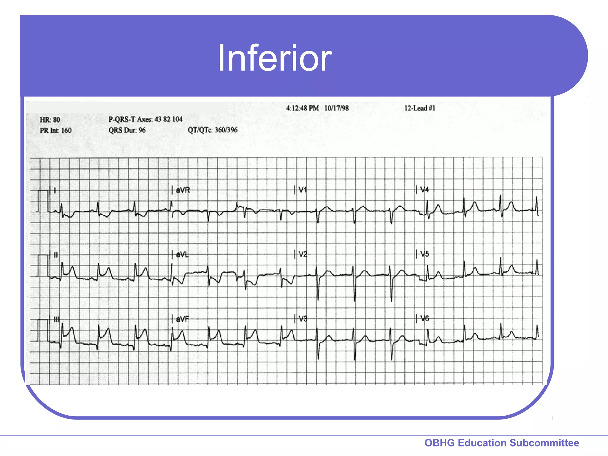 Chapter 6 - Introduction to 12 Lead Interpretation | PPT