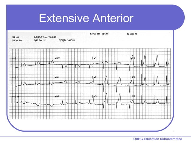 Chapter 6 - Introduction to 12 Lead Interpretation | PPT