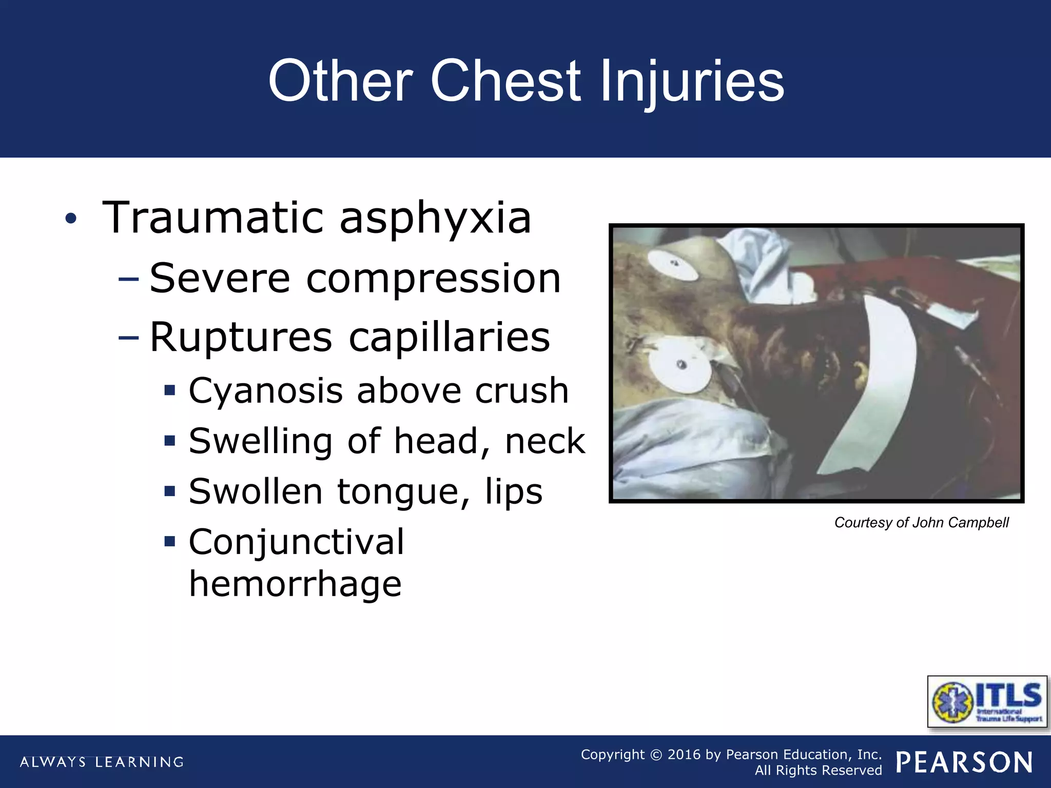 Chapter6 thoracic trauma | PPT