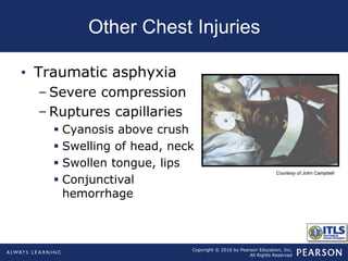 Chapter6 thoracic trauma | PPT