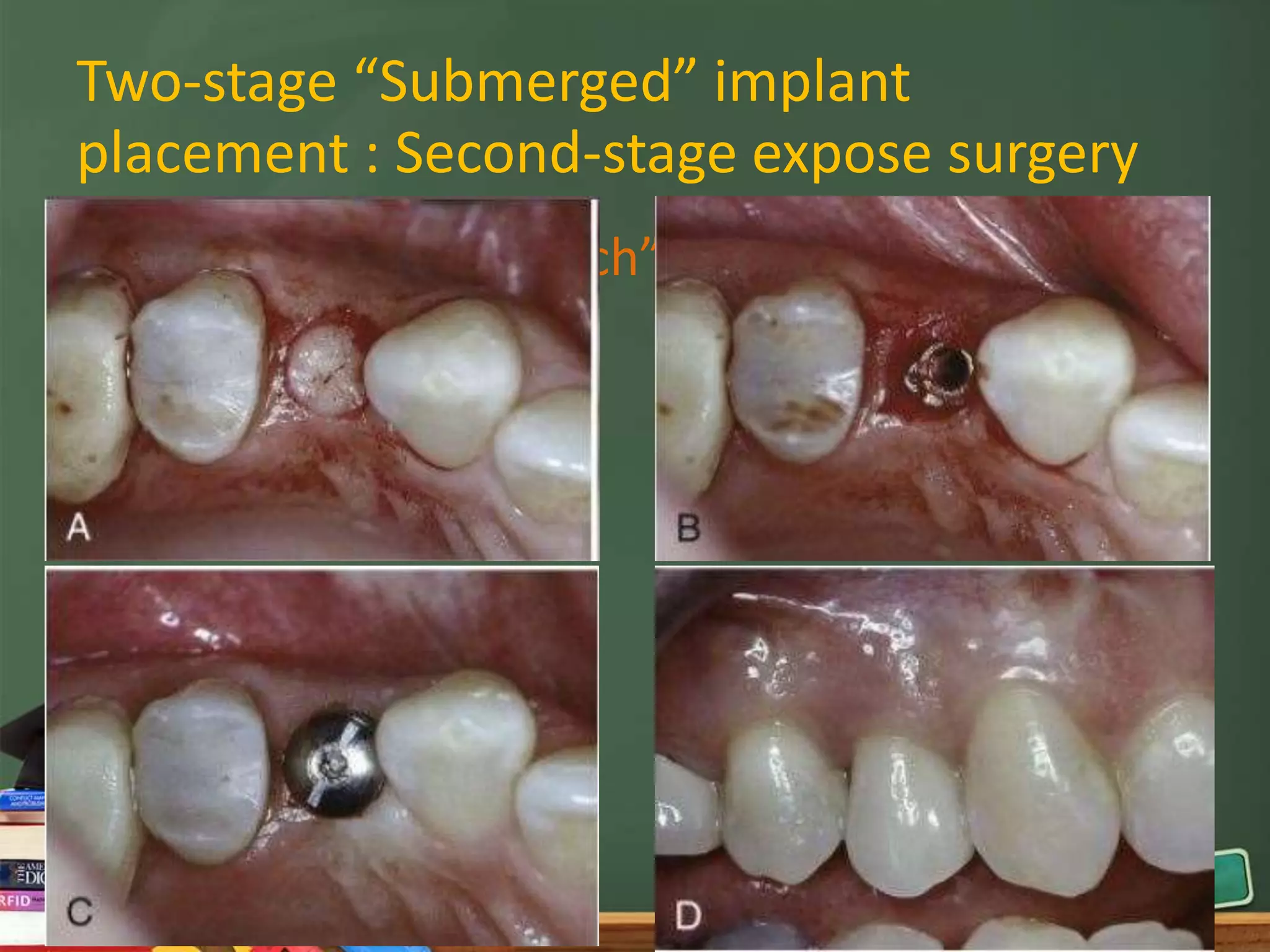 Standard Implant surgical procedure | PPTX | Dental Health | Diseases ...