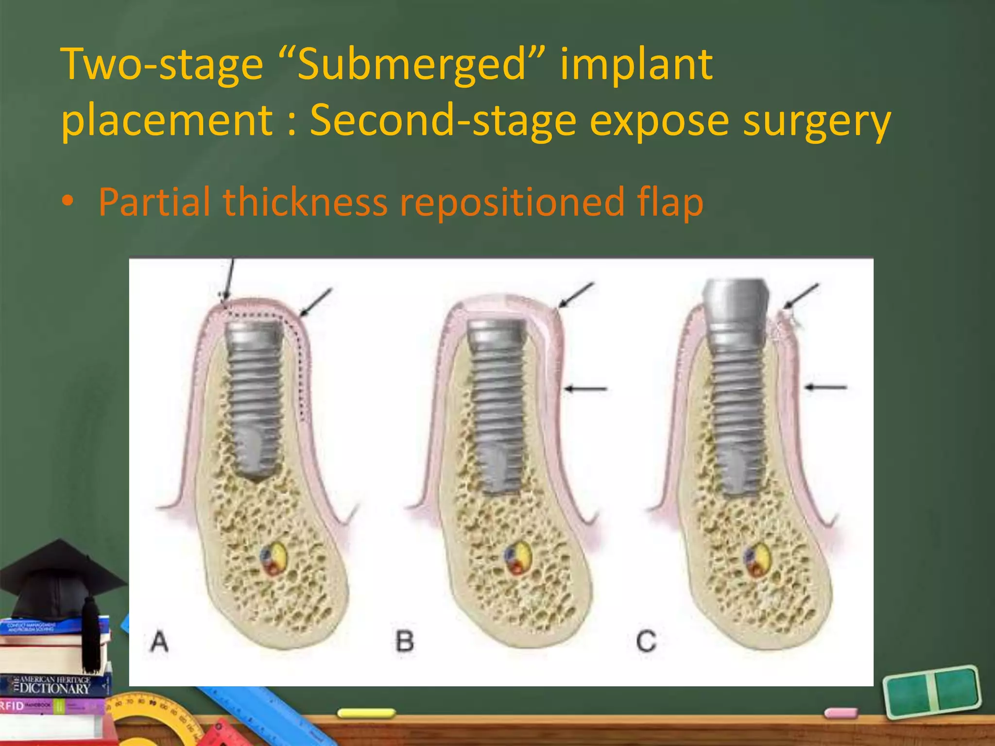 Standard Implant surgical procedure | PPTX | Dental Health | Diseases ...
