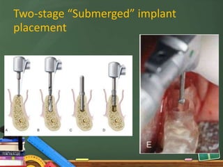 Standard Implant surgical procedure | PPT