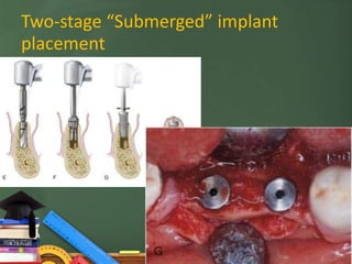 Standard Implant surgical procedure | PPTX