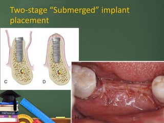 Standard Implant surgical procedure | PPT